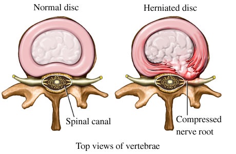 Disc Herniations and How Chiropractic Can Help