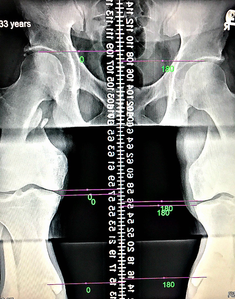Leg Length Discrepancy Fix Help At CORE Chiropractic Leg Length Discrepancy Fix Help At CORE Chiropractic